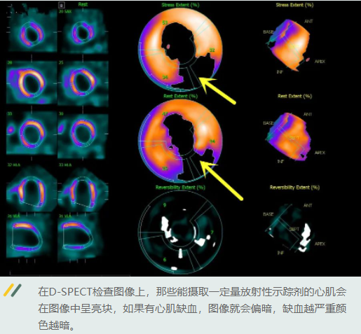 梅州市人民医院 广东首台心脏专用ECT（D-SPECT）亮相梅州！硬“核”技术看透“心”世界